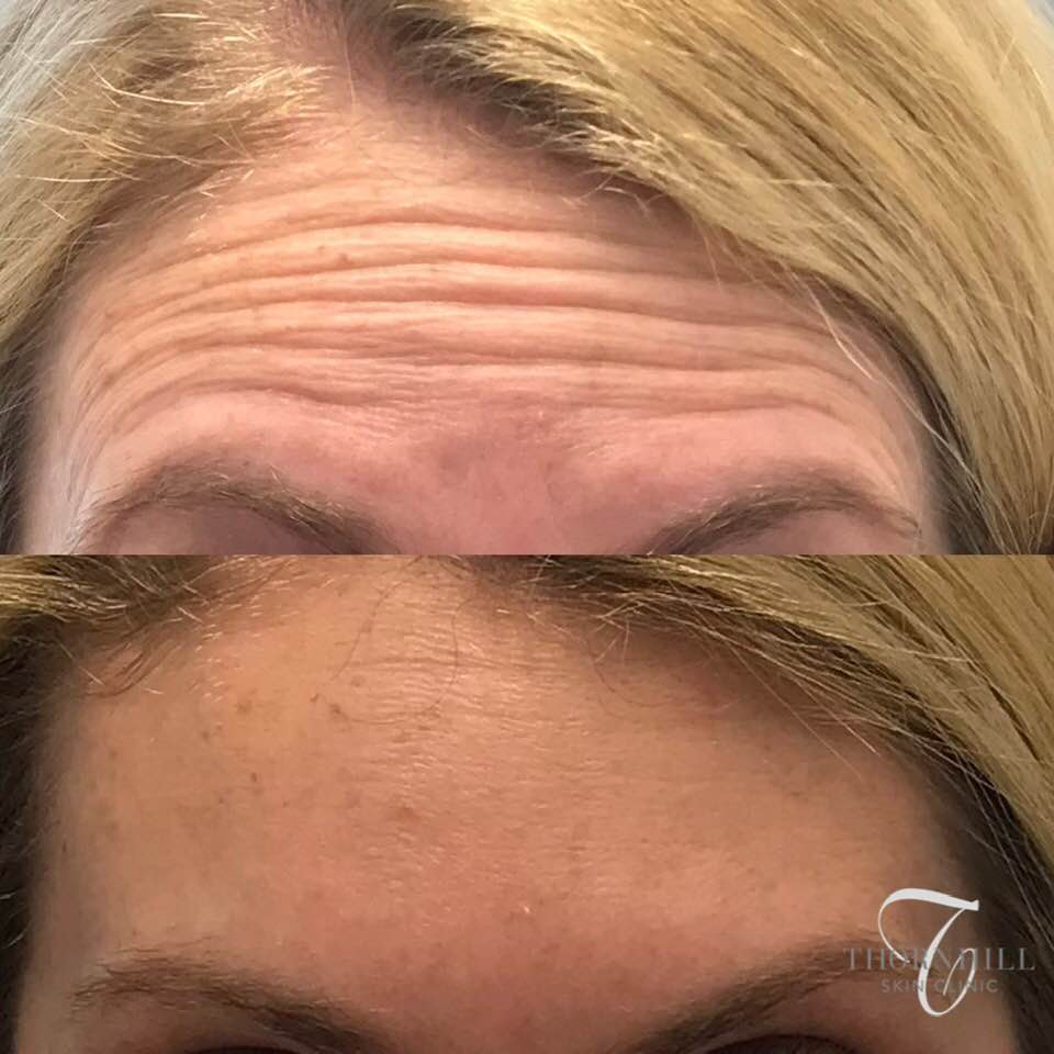 Botox and Dysport – THORNHILL SKIN CLINIC